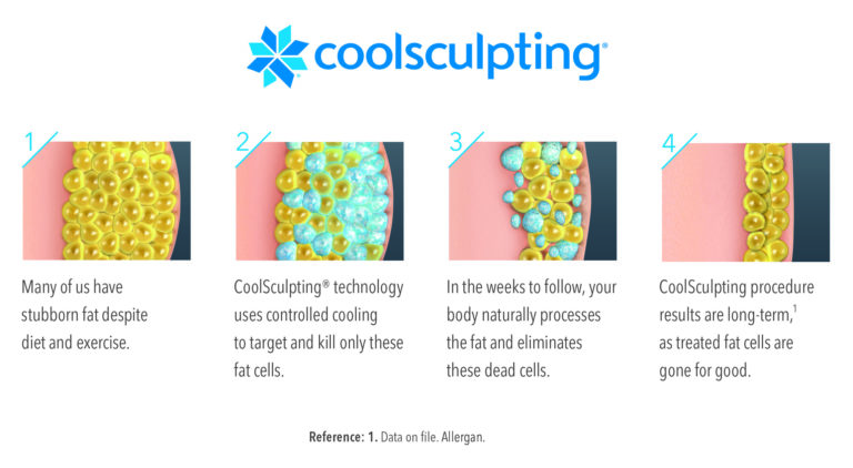 CoolSculpting® Procedure – Dr. Surfield